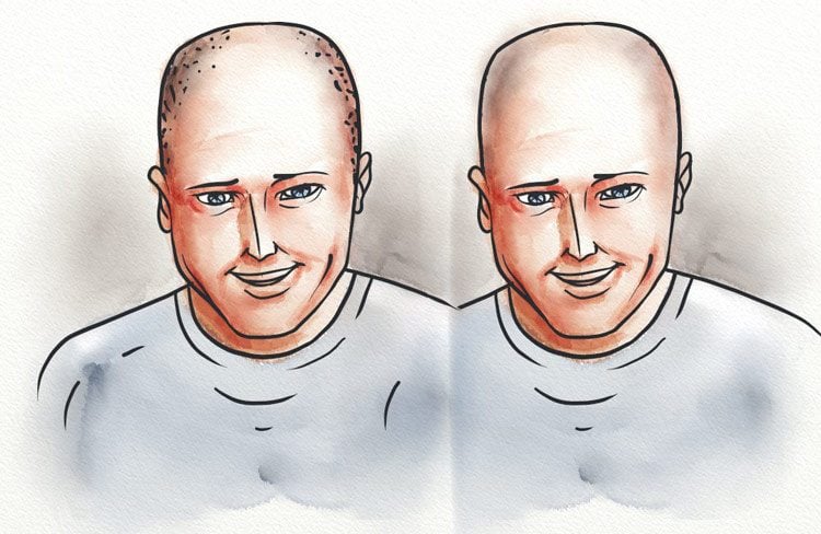 The Ultimate Guide To Scalp Micropigmentation - Hairguard