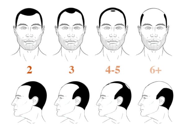Norwood 2 Hairline - Causes and Treatments | Hairguard
