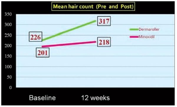Hair Miniaturization: What is it & 8 Ways to Help Stop It - Hairguard