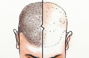 Norwood 2 Hairline - Causes and Treatments | Hairguard