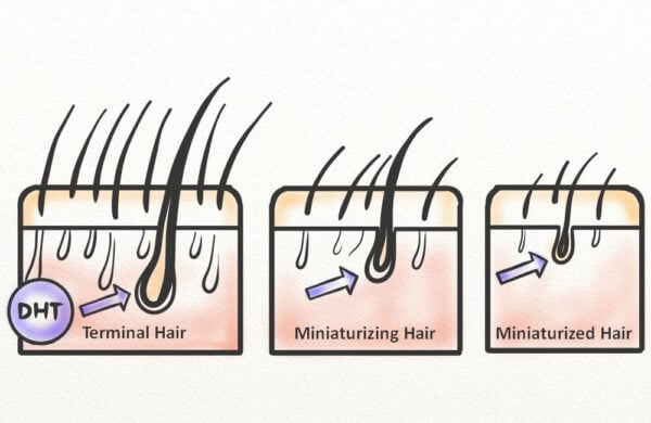 Norwood 2 Hairline - Causes and Treatments | Hairguard