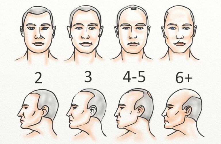 A Complete Guide To The Norwood Scale With 7 REAL Examples