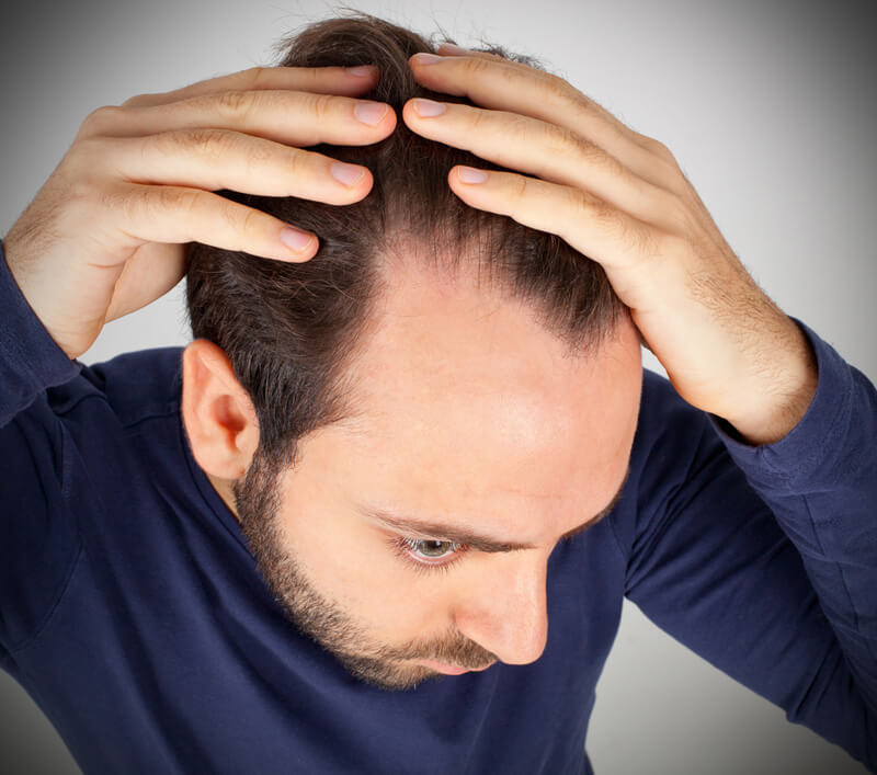 Hair Miniaturization What Is It 8 Ways To Help Stop It Hairguard Hair Miniaturization What Is It 8 Ways To Help Stop It Hairguard