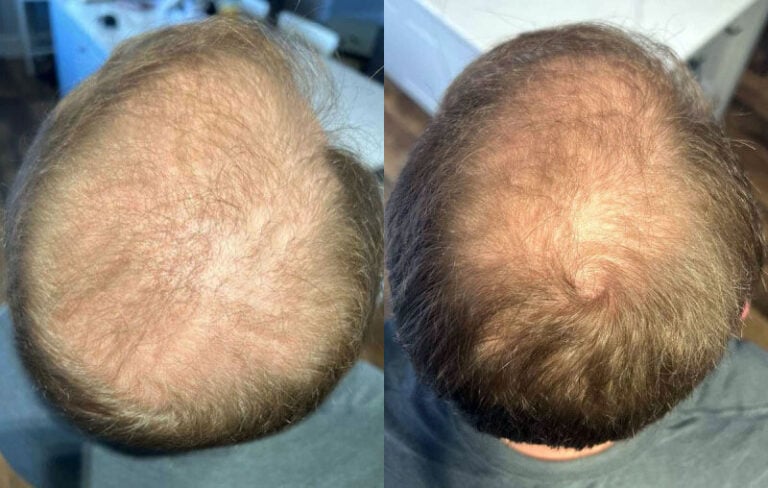 Growband Pro Scalp Massager - Hairguard