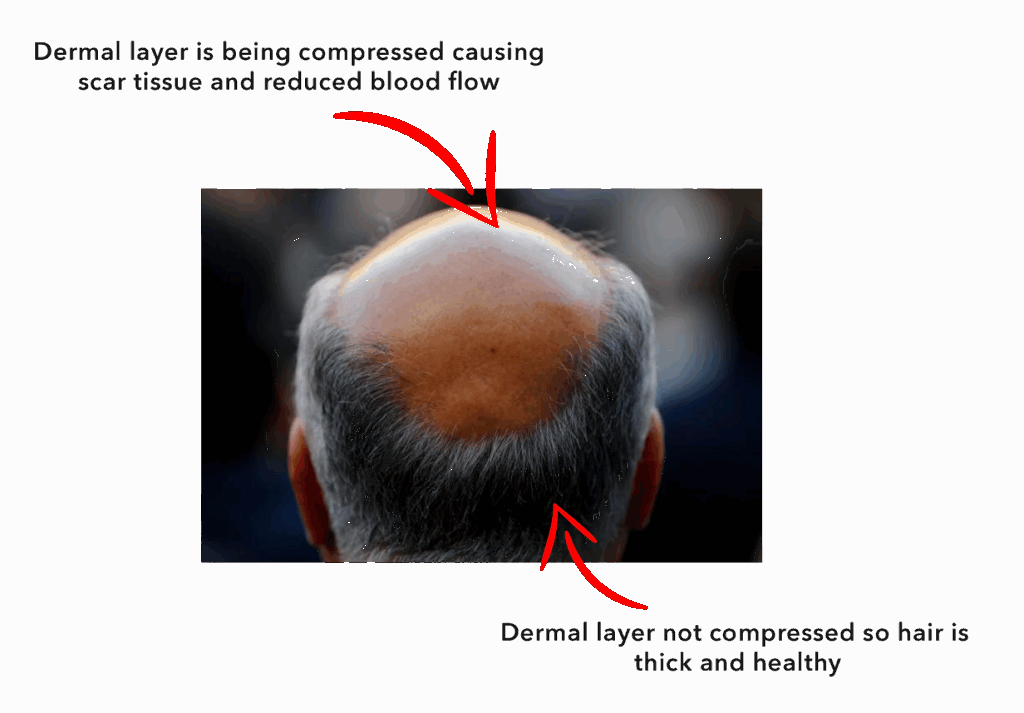 What Causes Hair Loss? - Hairguard